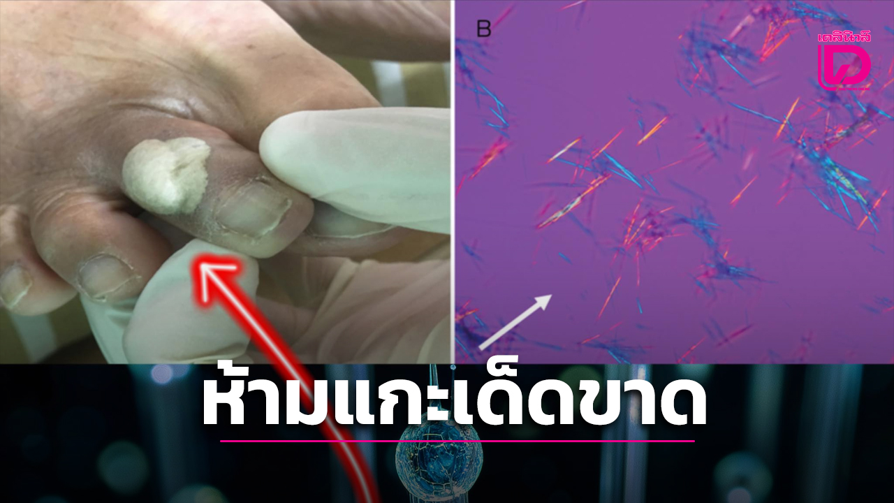 เจอก้อนแบบนี้ห้ามแกะ-เกา เด็ดขาด มันคือ 'Bullous Tophus' ในเกาต์ ...