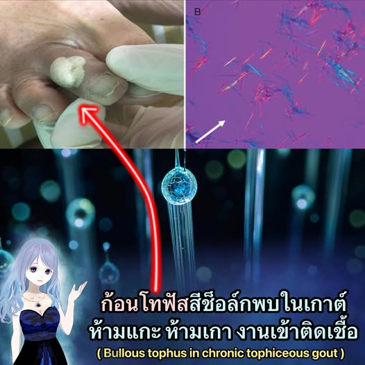 เจอก้อนแบบนี้ห้ามแกะ-เกา เด็ดขาด มันคือ 'Bullous Tophus' ในเกาต์ ...